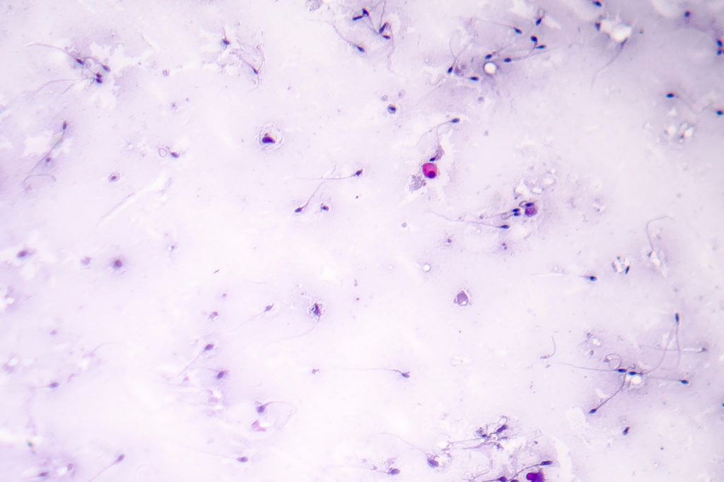 Asthenozoospermie: Ursachen und Behandlung - IVI