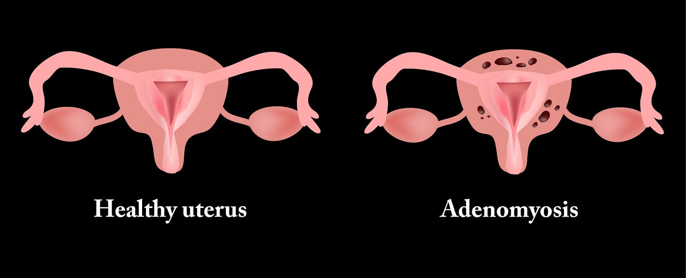 Adenomyose und Schwangerschaft: ist es möglich?